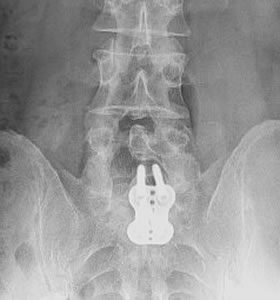 Anterior Lumbar Interbody Fusion (ALIF): - Center for Advanced Spine ...