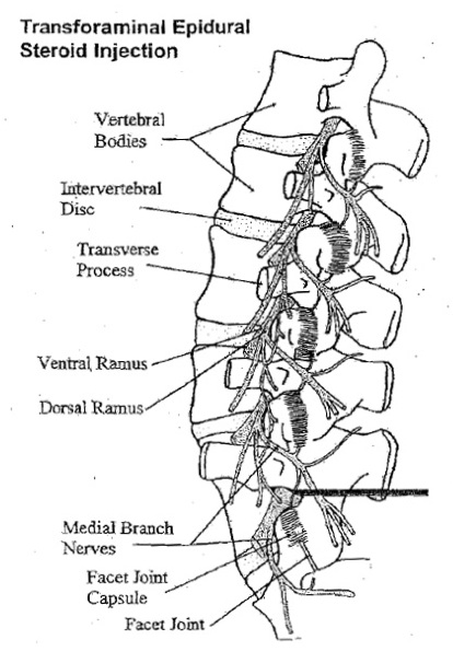 Epidural Steroid Injection – Center for Advanced Spine Care of Southern ...