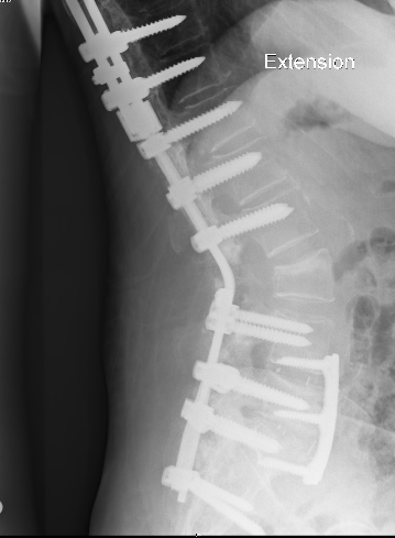 S2 Iliac Fixation – Center for Advanced Spine Care of Southern Arizona