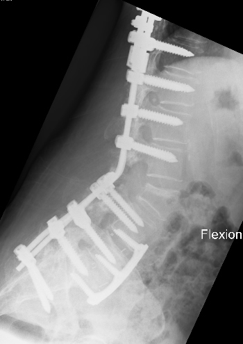S2 Iliac Fixation – Center for Advanced Spine Care of Southern Arizona