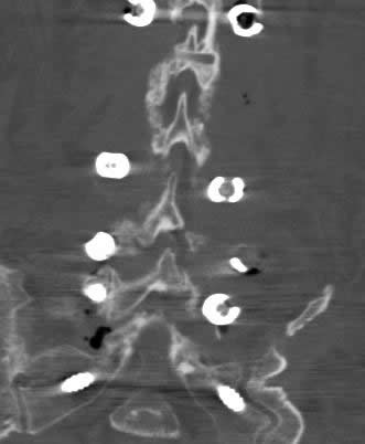 S2 Iliac Fixation – Center for Advanced Spine Care of Southern Arizona