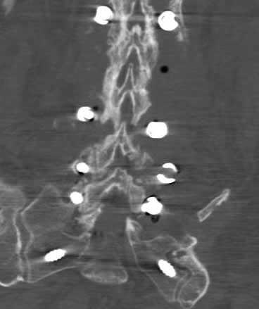 S2 Iliac Fixation – Center for Advanced Spine Care of Southern Arizona