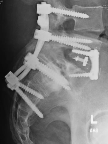 S2 Iliac Fixation – Center for Advanced Spine Care of Southern Arizona